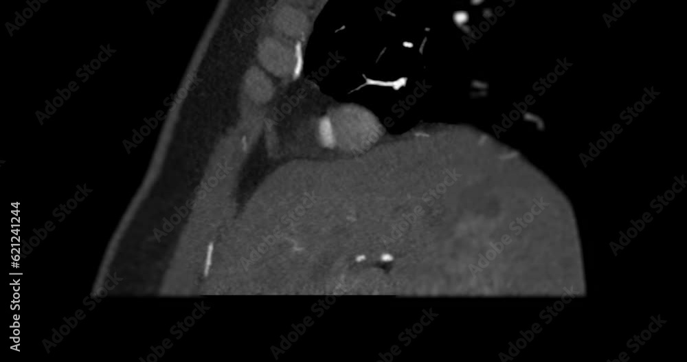 CTA Coronary artery in vertical long axis view show anatomical of the ...