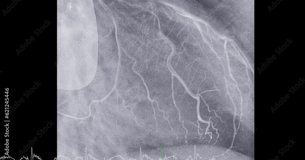 Cardiac catheterization showing coronary arteries used to diagnose and ...