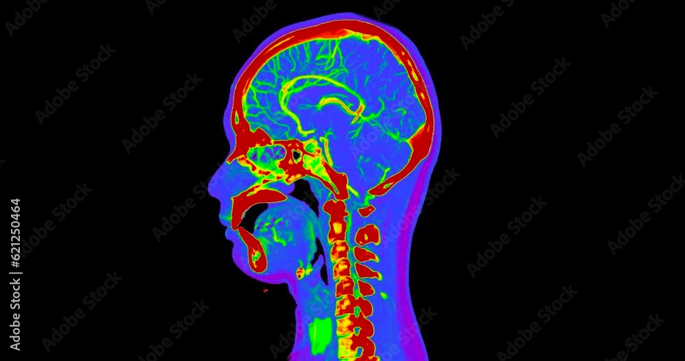 CT Scan of the brain sagittal plane in color mode for diagnosis stroke ...