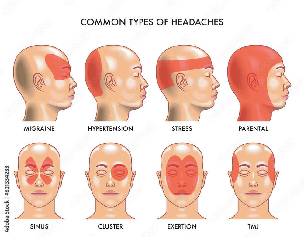 Medical Illustration of common types of headaches. Stock Illustration ... Medical Illustration of common types of headaches. Stock Illustration ...