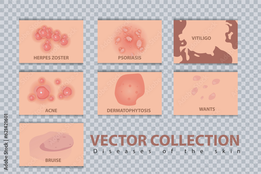 Different types of psoriasis vector set. Part of patients skin with ...