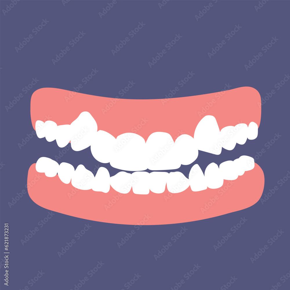 Orthodontic teeth problem crowding. Abnormal eruption. Double tooth ...