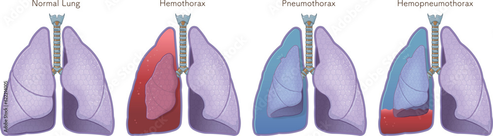 lungs,windpipe,hemothorax,pneumothorax,hemopneumothorax,illustration ...