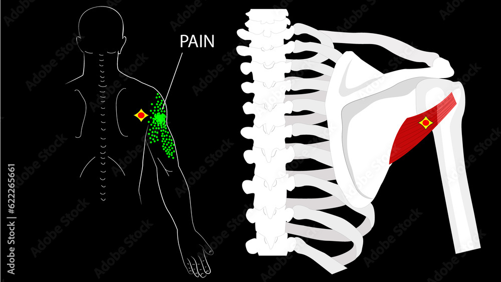 Teres minorr muscle. Trigger points and referred pain in the arm and ...