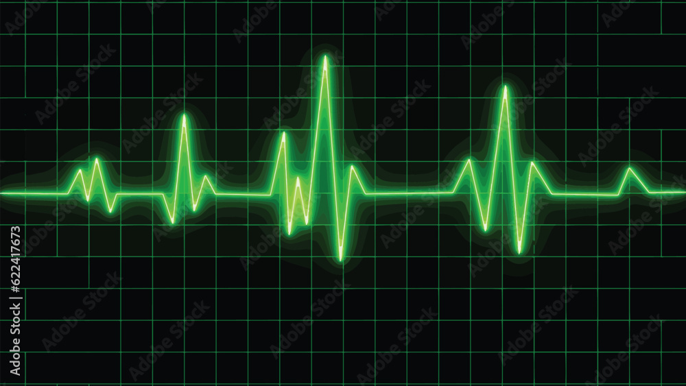 Electrocardiogram show (STEMI) pattern. Heart attack. Ischemic ...
