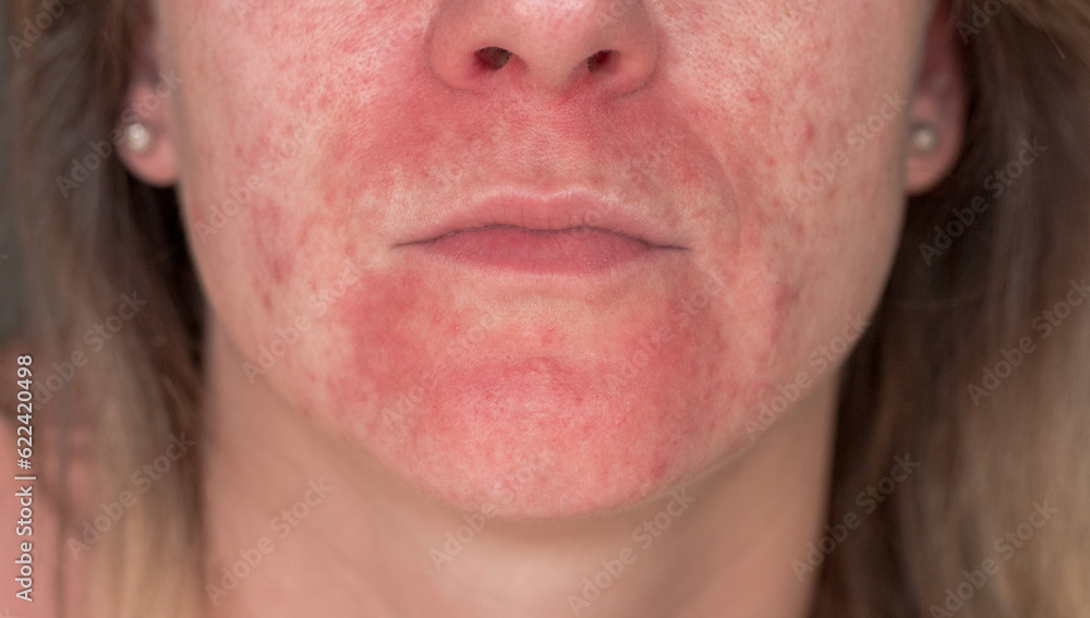 Seborrheic Dermatitis In the face of a young girl. Acne vulgaris and ...