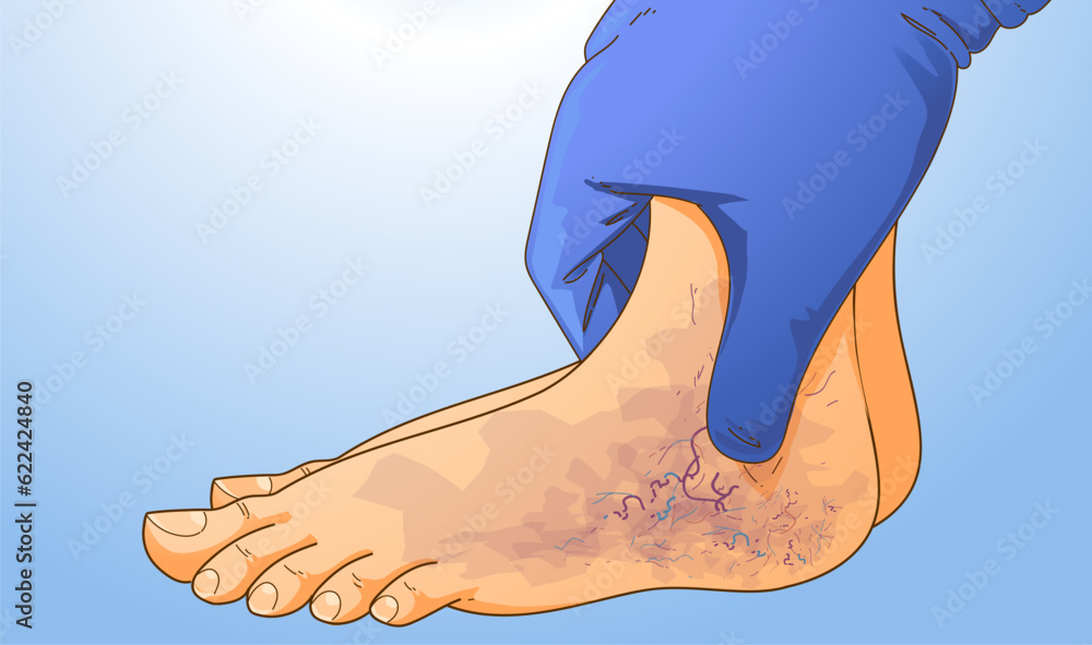 Human legs with health problems. Bruise, hematoma. Varicose veins ...