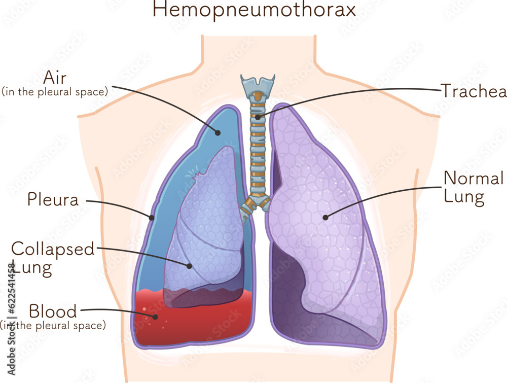 Poster lungs,windpipe,hemothorax,pneumothorax,hemopneumothorax ...