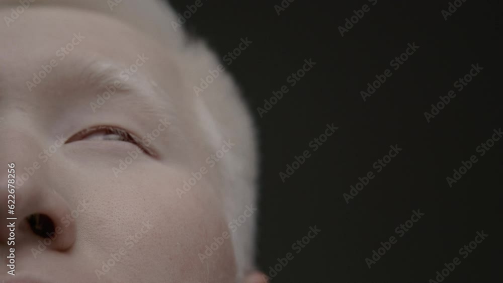 Close up portrait of one eye Asian albino guy. Genetic mutation of the ...