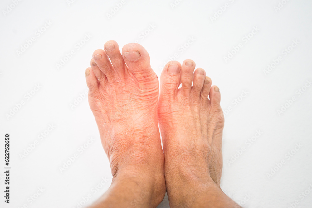 deteriorated body parts of older persons Stock Photo | Adobe Stock