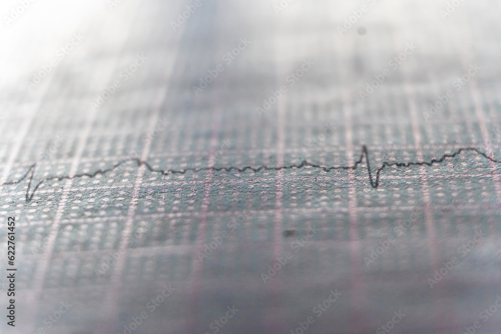 Medical cardiogram printed on paper. Electrocardiogram chart. Clinic ...