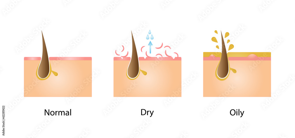 Normal, oily, and dry pores. Human Skin types and conditions on white ...