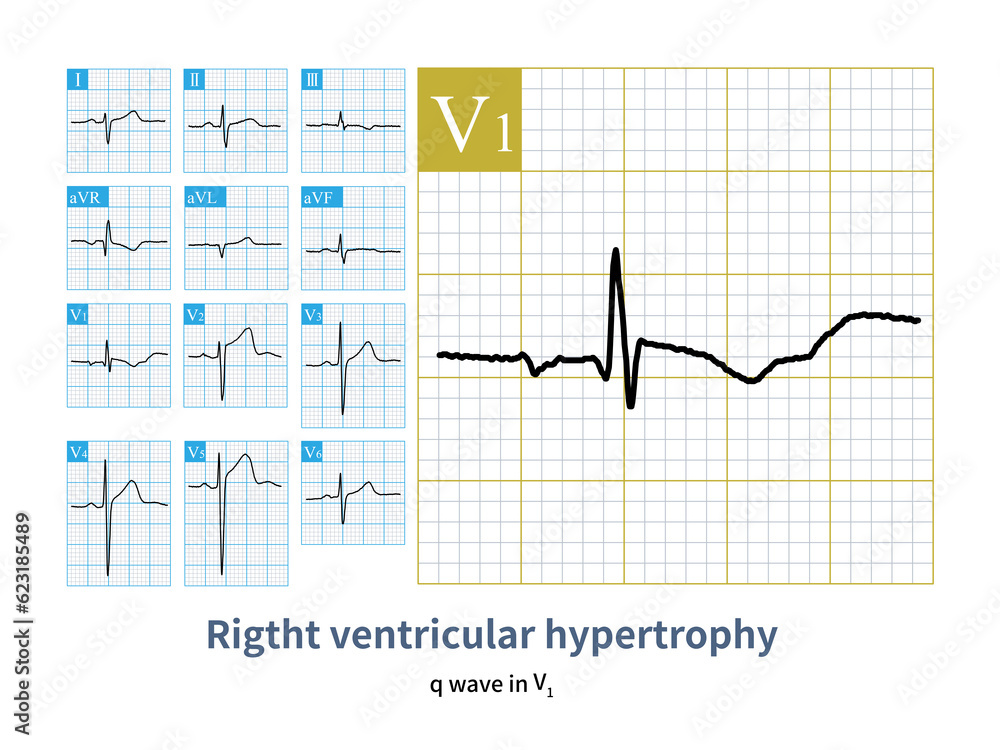 Male 40 Years Old Clinically Diagnosed With Atrial Septal Defect Qrs Waves Showed Qrs