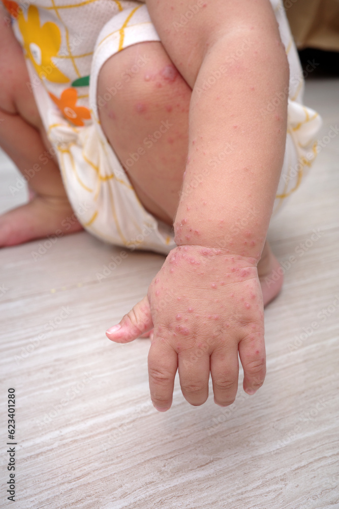 the hand of a baby with multiple red, swollen blisters, which are ...