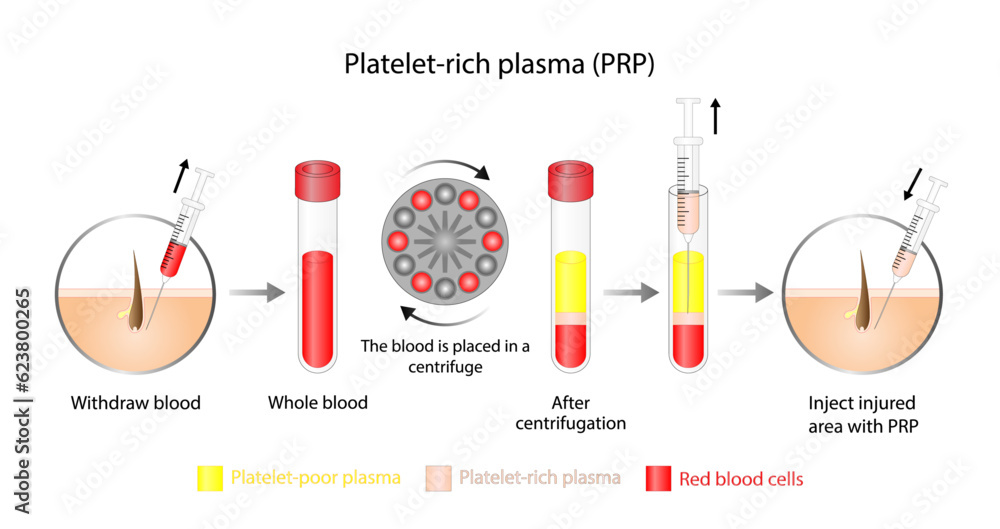 Platelet-rich plasma (prp). Autologous conditioned plasma, is a ...