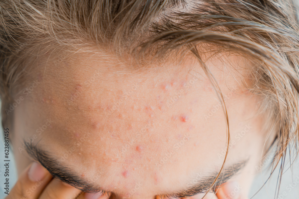 Acne on teenage boy forehead. Child is upset because of skin problems ...