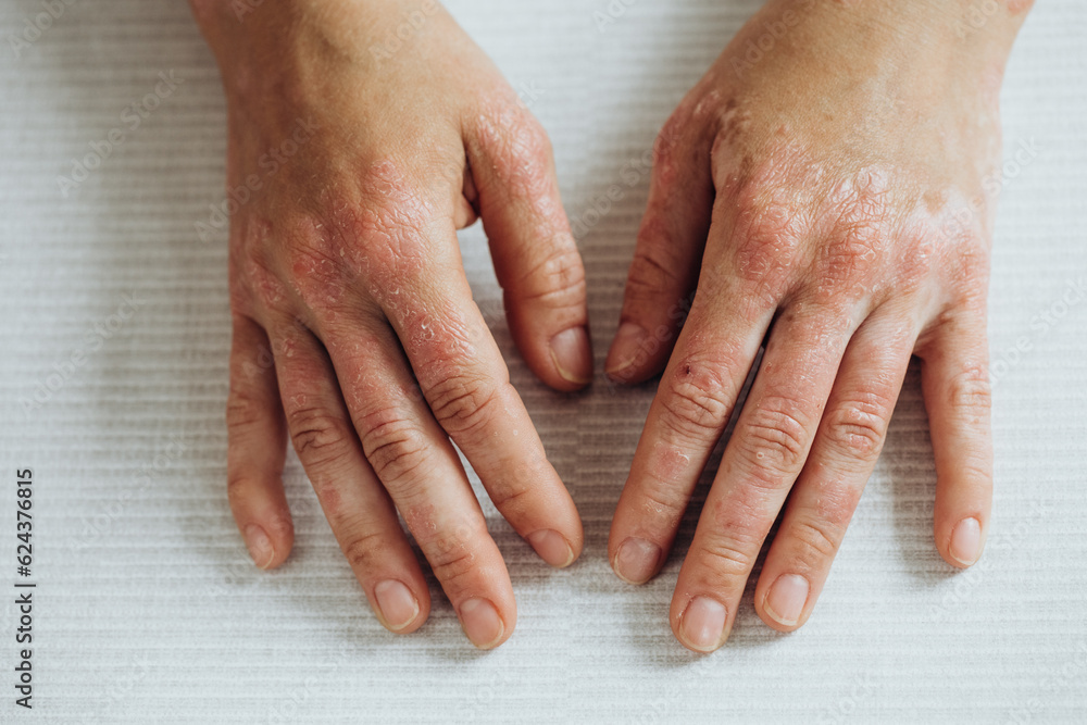 Psoriasis. Acute psoriasis on the knees, body, elbows is an autoimmune ...