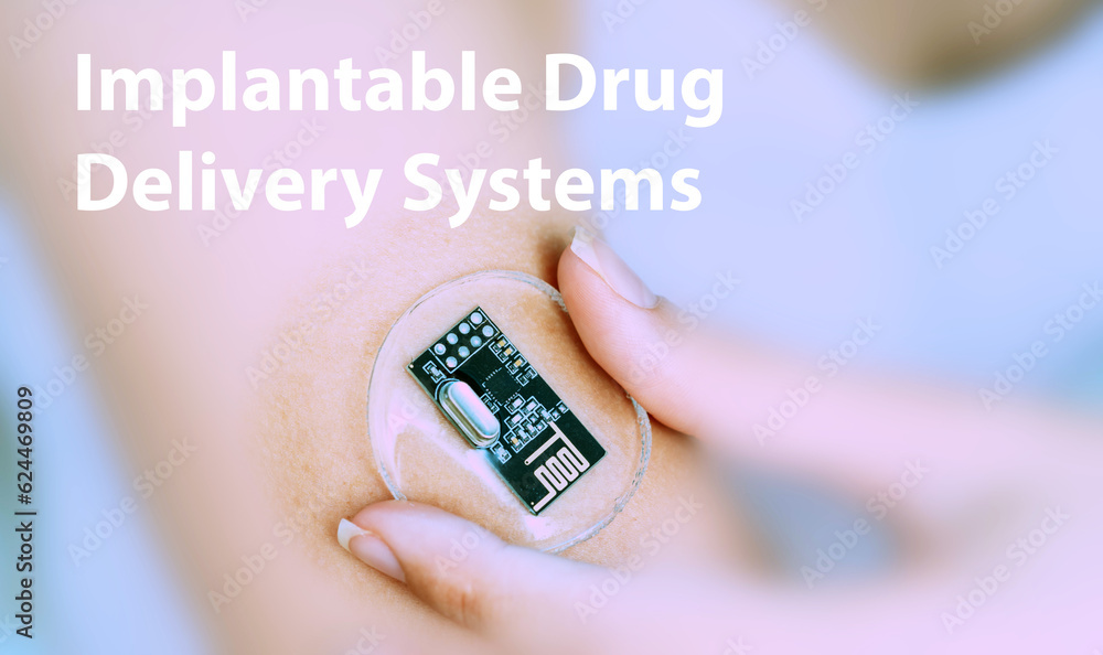 Foto De Implantable Drug Delivery Systems Implantable Electronic
