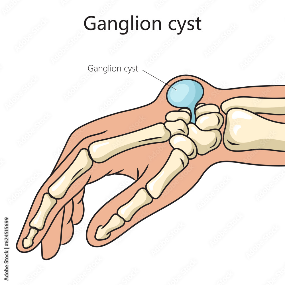Poster Foto Ganglion Cyst Structure Disease Diagram Schematic Vector Illustration Oleksandr