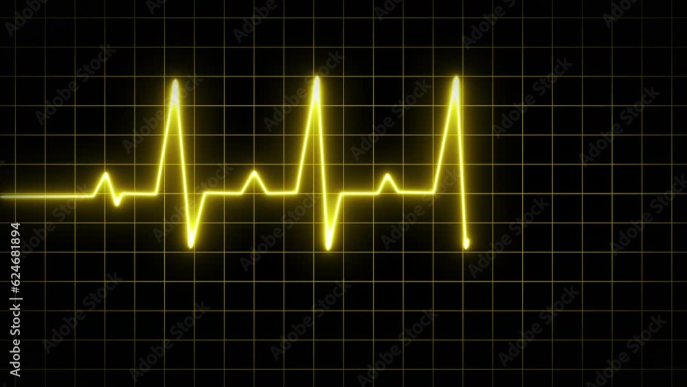 Animation of an ECG showing atrial fibrillation. ECG exhibiting brief ...