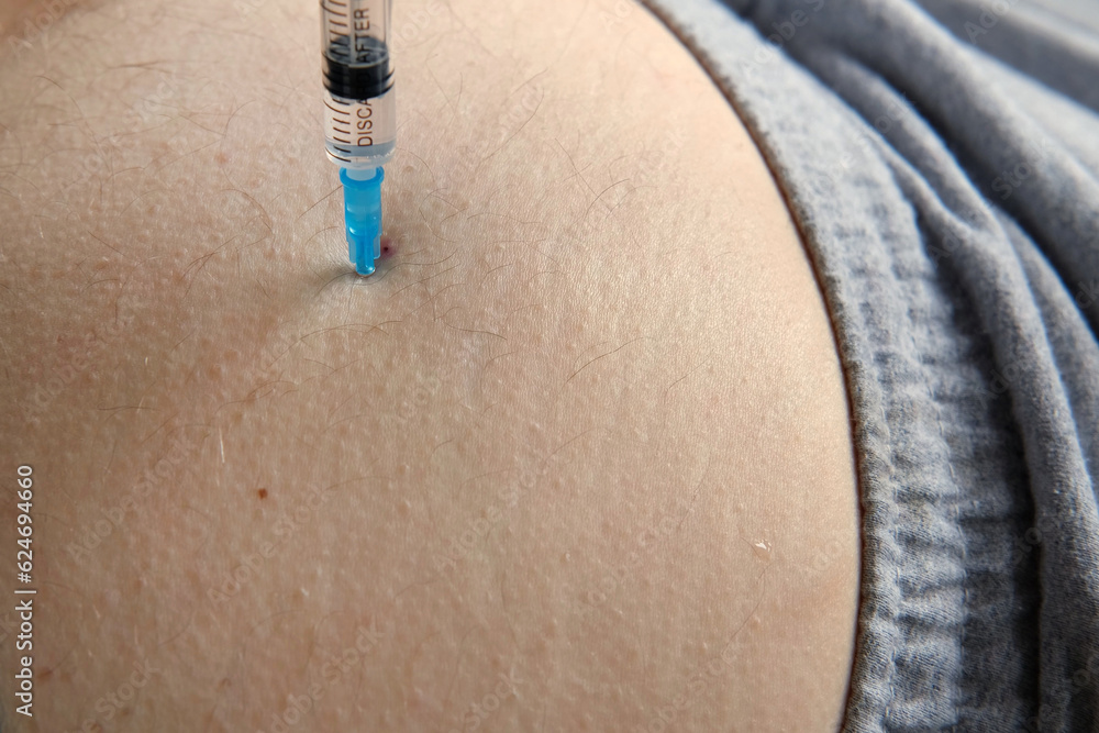 Needle injecting into the muscle. Nurse doing a trigger point injection ...