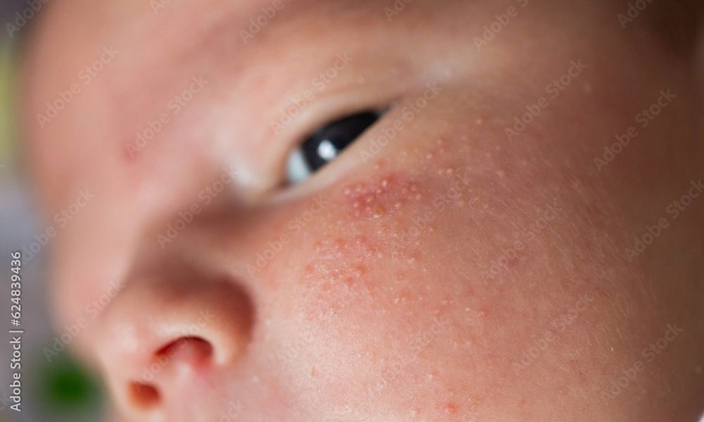 Rash on the face of a newborn baby. The process of formation of the ...