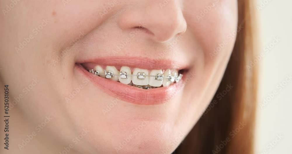 Beautiful woman smile in orthodontic braces on teeth, close up ...