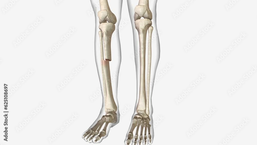 open fracture, also called a compound fracture, is a fracture in which ...