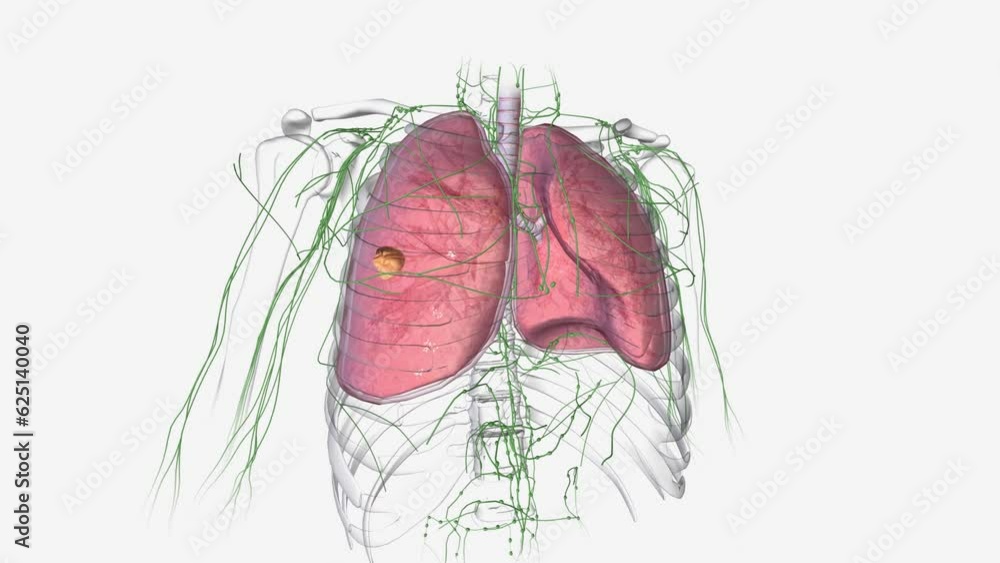 In stage 2A lung cancer, the tumor measures between 4 cm and 5 cm and ...