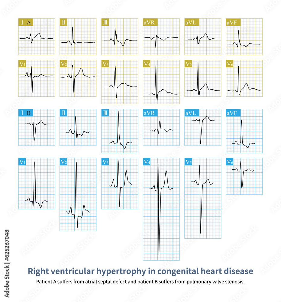 Different patients with congenital heart disease have different ECG ...