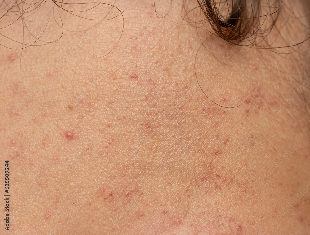 Foto de allergic red rash on the face. do Stock | Adobe Stock