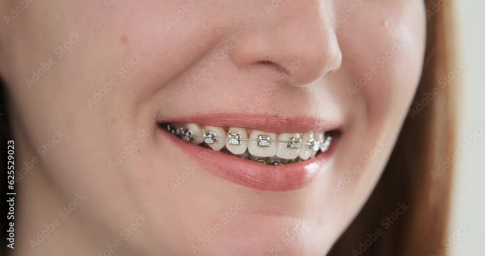 Close up, beautiful woman smile in orthodontic braces, crop face. Happy ...