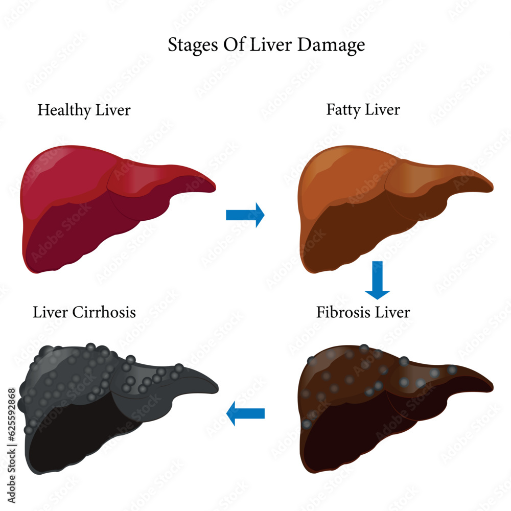 Stages of liver damage. Healthy, fatty, liver fibrosis and cirrhosis ...