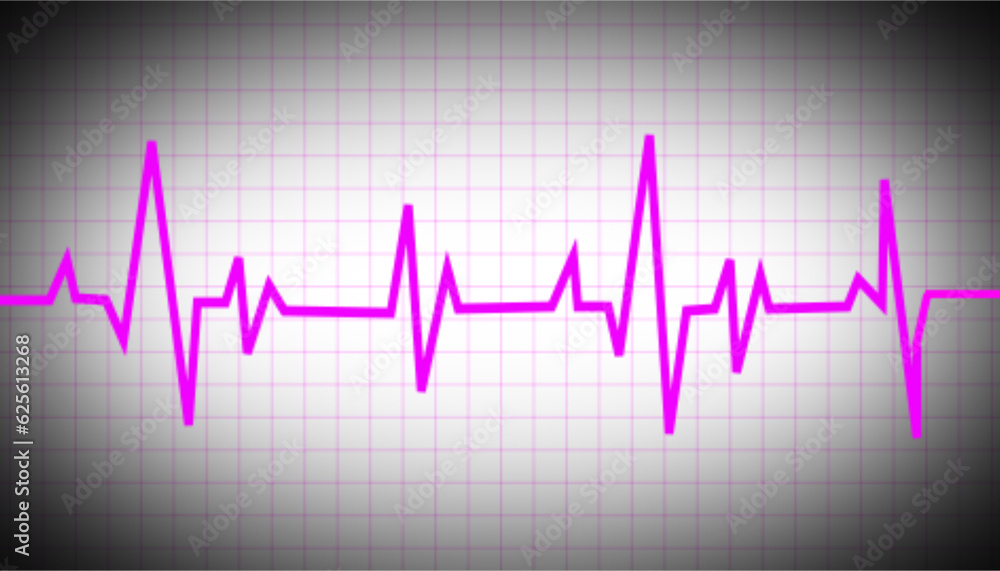 An electrocardiogram reveals Pattern of sinus tachycardia. Fibrillation ...