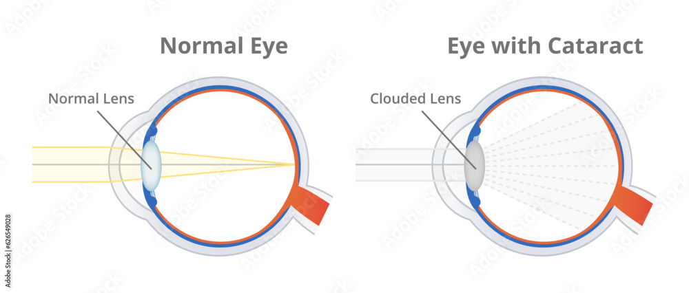 Anatomical vector scheme or illustration of a normal healthy eye and ...