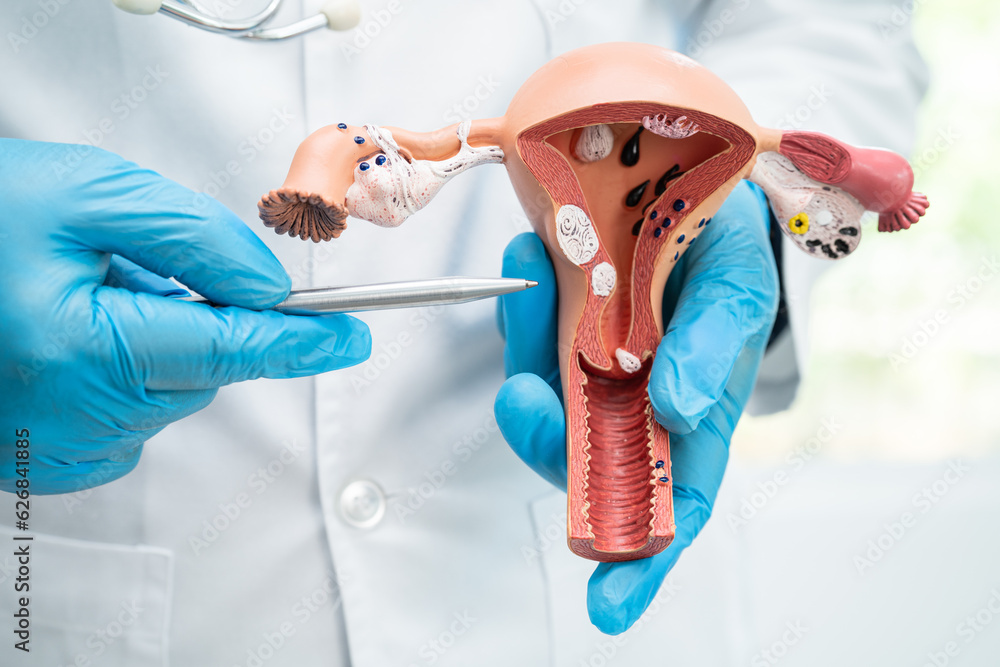 Uterus, doctor holding anatomy model for study diagnosis and treatment ...