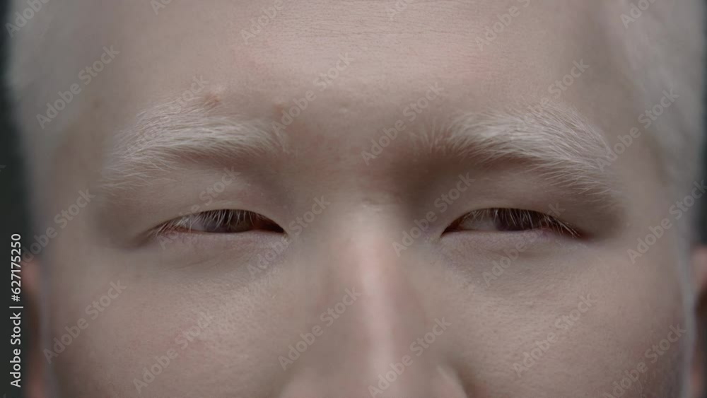 Close up portrait of the eye of an Asian albino guy. Genetic mutation ...