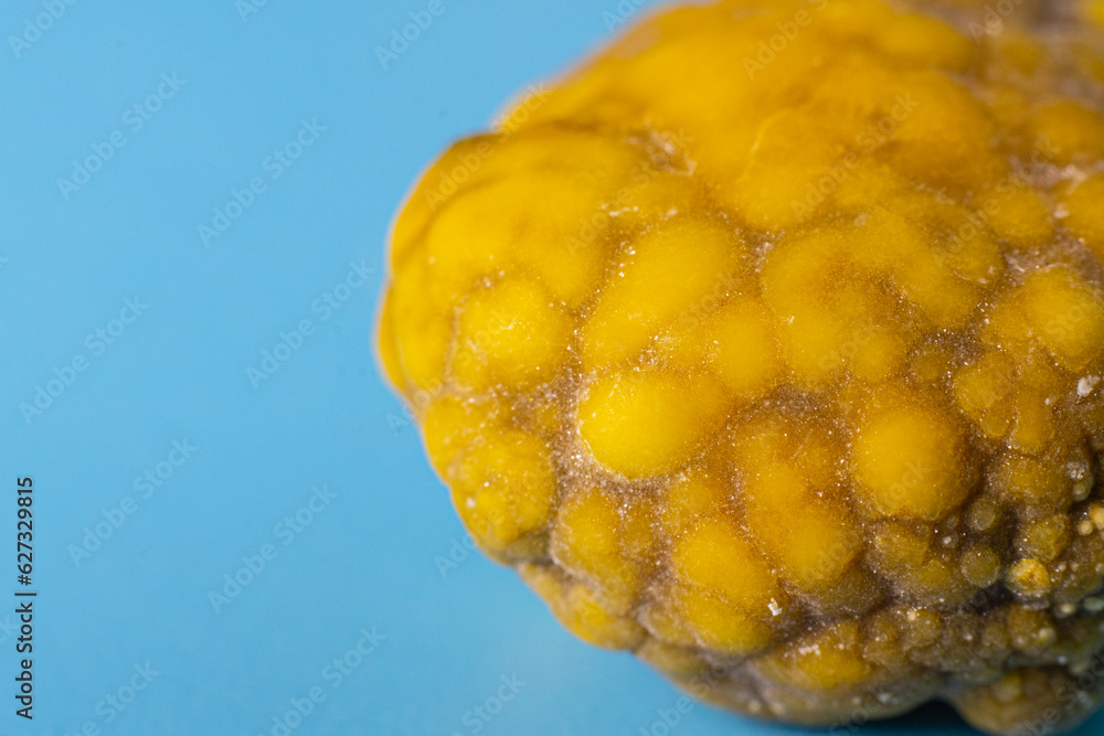 Gallstones,multiple cholesterol stone in gallbladder with cholecystitis ...