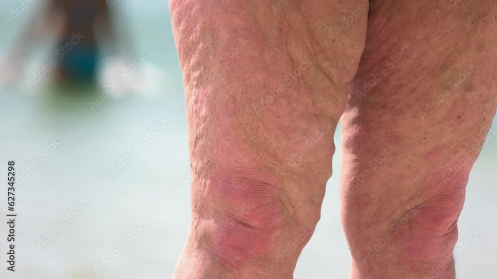 Close up obesed wrinkled legs of retired lady on the beach. Cellulite ...