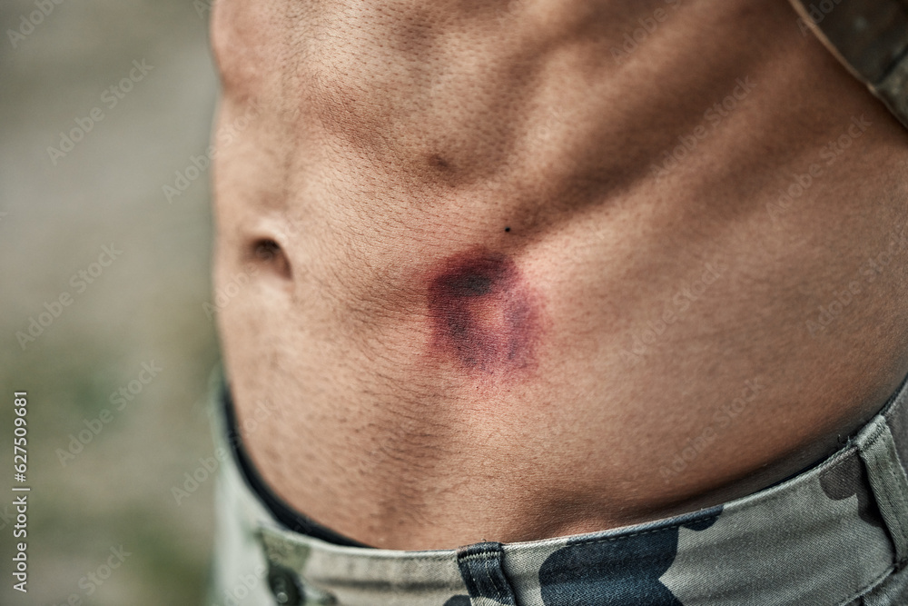 Paintball injury, stomach bruise and man in closeup with pain, shooting ...