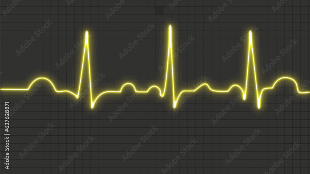 Normal heart rhythm (normal sinus rhythm). Neon human heart normal ... Normal heart rhythm (normal sinus rhythm). Neon human heart normal ...