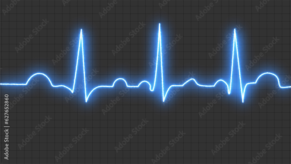 ECG example of a normal sinus rhythm. Neon human heartbeat normal sinus ...