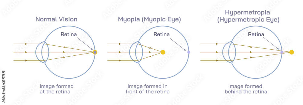 Difference between Hyperopia and myopia. The distant object becomes ...