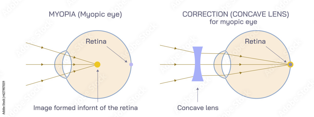 Difference between Hyperopia and myopia. The distant object becomes ...