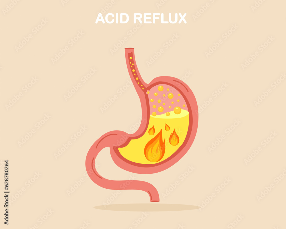 Suffering from GERD symptom with acid reflux Stomach heartburn with ...