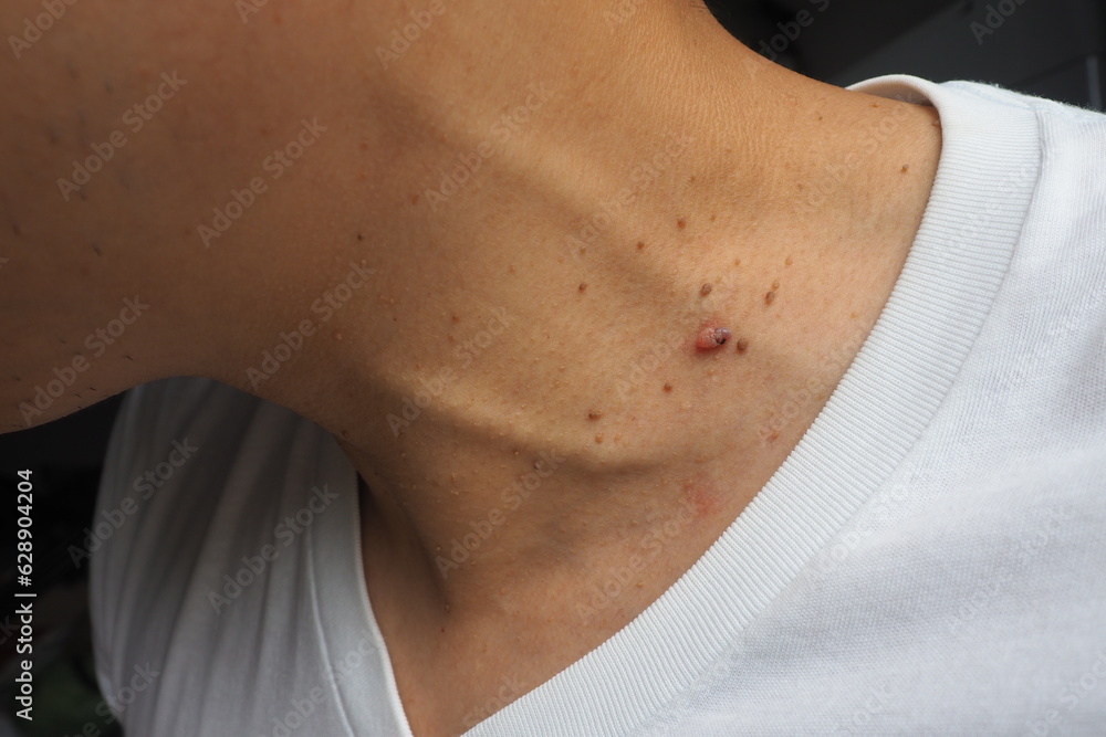 Many skin tags or Acrochordon on the neck of an Asian male. They are ...