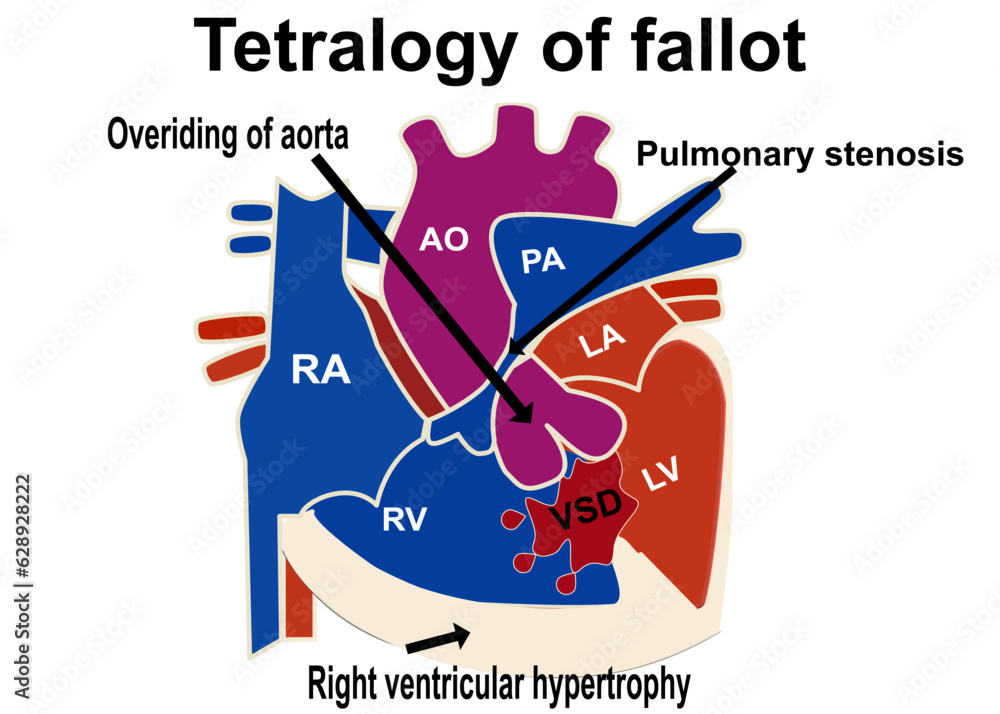 Fototapeta The picture show the structure of tetralogy of fallot that ... Fototapeta The picture show the structure of tetralogy of fallot that ...