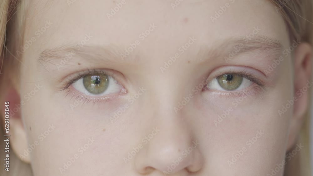 Close-up swollen and inflamed eye teen girl looks at the camera. A ...