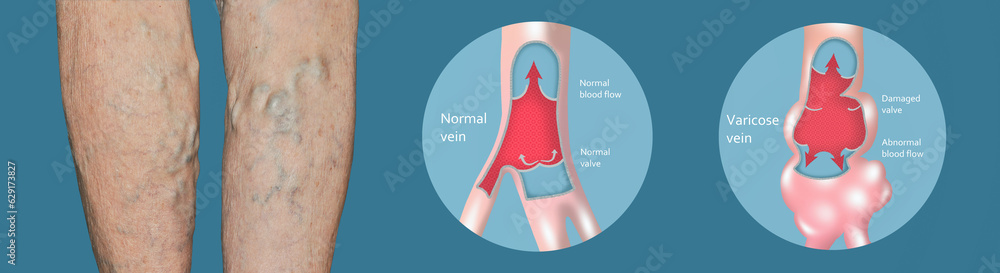 Varicose veins on a female senior legs. The structure of normal and ...