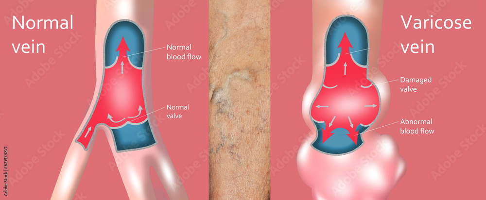 Varicose veins on a female senior legs. The structure of normal and ...